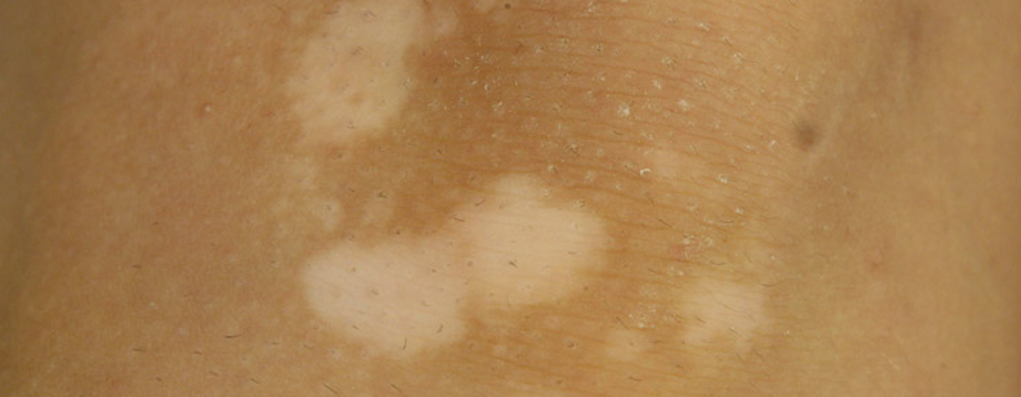 Pigmentstoornissen in uw huid, wat is het precies?